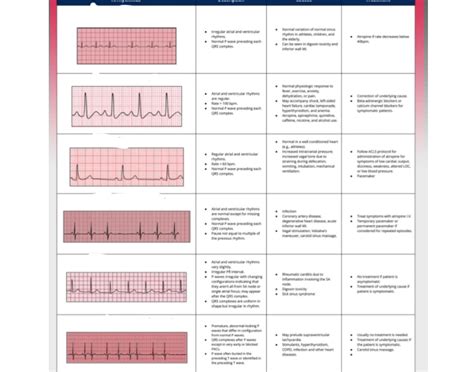 Ekg Identification Quiz