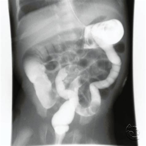 Meconium Plug Syndrome Medical Junction