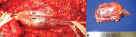 Photograph Of The Surgical Field Showing A Tumor On The Left