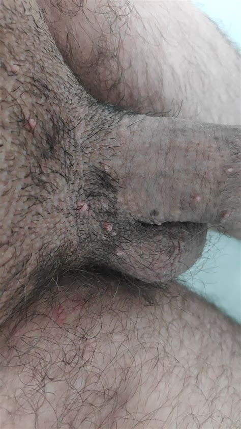 Having Sex With Molluscum Contagiosum R Molluscum
