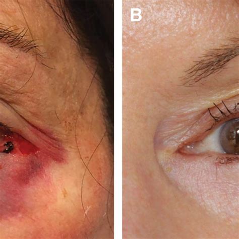 Pretarsal Lower Lid Defect 50 Of Lid Width Type I A A