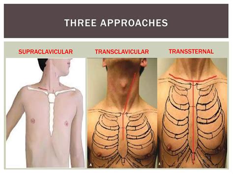 Anterior Approaches To The Thoracic Spine Pptx