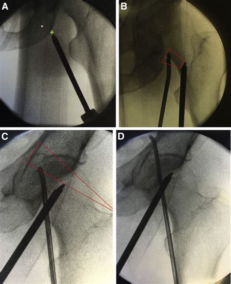 Figure 2 From Endoscopic Sciatic Nerve Decompression In The Prone