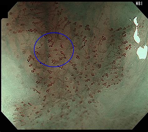 Further Destruction Of Ipcl With Elongation Of Microvessels In Vertical