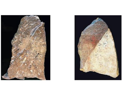 Pneumonia Classification And Etiology Ppt