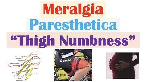 Meralgia Paresthetica Numbness Of The Thigh” Causes Symptoms Diagnosis Treatment