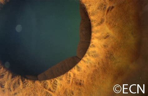 Iris Tumors New York Eye Cancer Center