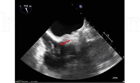 Figure 1 From Right Sided Infective Endocarditis Semantic Scholar
