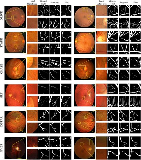 Frontiers Mfa Unet A Vessel Segmentation Method Based On Multi Scale Feature Fusion And