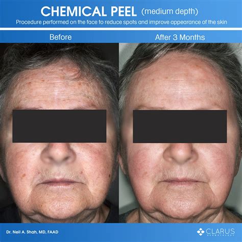 Chemical Peel On The Face To Reduce Spots And Improve Appearance Of The Skin Clarus