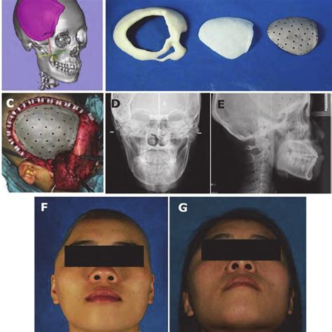 Pdf Rapid Prototyping In Correction Of Craniofacial Skeletal Deformities