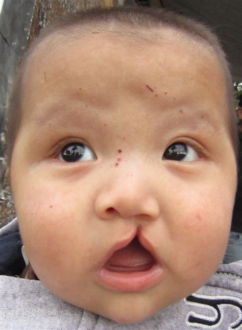 With Cleft Lip And Palate