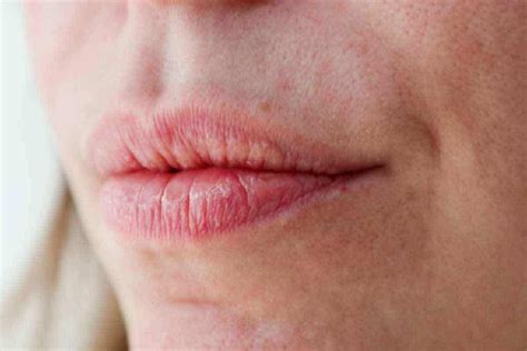 Why Do Lips Turn Pale Understanding Anemia Lips Liv Hospital