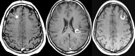 Esclerosis Múltiple