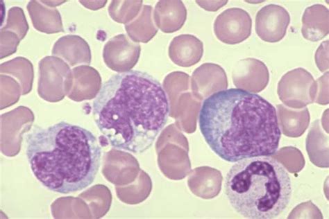 Reactive Lymphocytes Vs Monocytes Reactive Lymphocytes Vs Monocytes