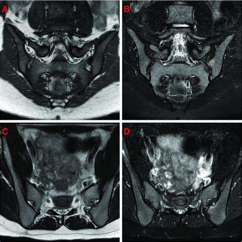 Mri Of The Sacrumpelvis Performed 4 Years Earlier With A Coronal T1