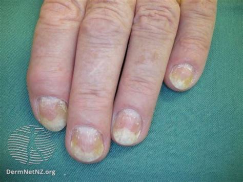 Tackling And Treating Onycholysis