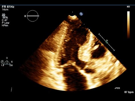 Basic Echo Hocm Hypertrophic Obstructive Cardiomyopathy And Hcm Or