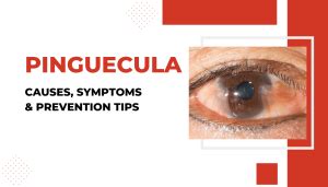 Pinguecula Causes Symptoms And Prevention Tips Laxmi Eye Hospital