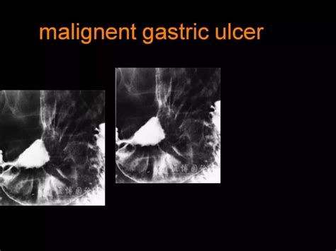 44 Dr Ahmed Esawy Imaging Oral Board Of Bowel Imaging Part Ii Stomach