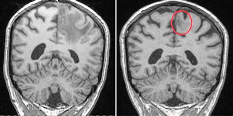 Cerebral Toxoplasmosis In An Hiv Infected Patient