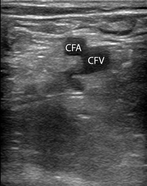 Ultrasound Guided Central Line Placement Made Easy Step By Step Guide