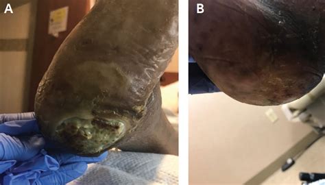 Directional Atherectomy And Drug Coated Balloon Therapy For Leaving