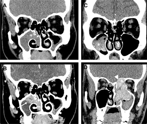 Imaging Of Odontogenic Sinusitis Otolaryngologic Clinics Of North America