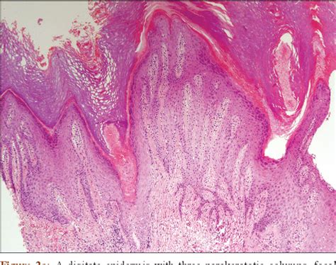 Intergluteal Cleft Semantic Scholar