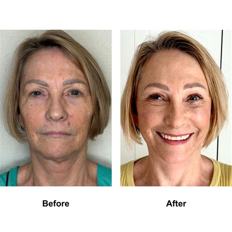 Jocelyn Had Facelift Surgery In Thailand With Dr Ring