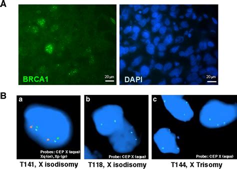 X Chromosomal Abnormalities In Basal Like Human Breast Cancer Cancer Cell