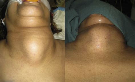 Nodular Goiter