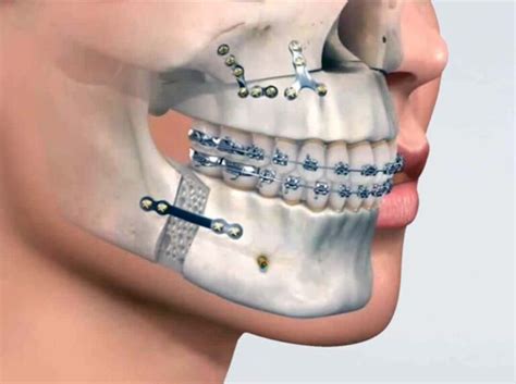 Jaw Surgery For Overbite Procedure Recovery And When Its Needed