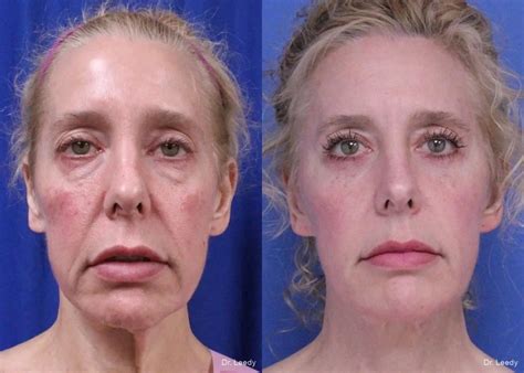 Neck Lift Before And After Gallery