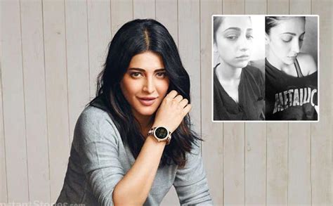 Hats Off Shruti Haasan Admits Undergoing Plastic Surgery “not Ashamed