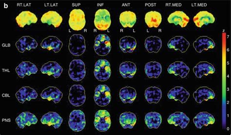 Principles Of Brain Perfusion Spect Radiology Key Principles Of Brain Perfusion Spect Radiology Key