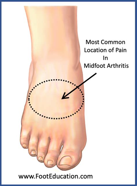 Midfoot Arthritis Footeducation