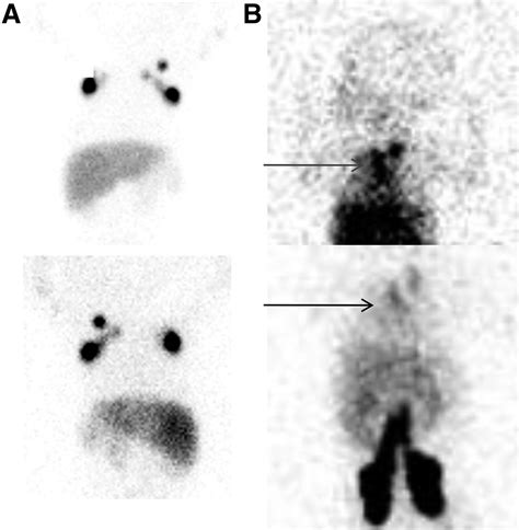 Lymphoscintigraphy Of Chylous Anomalies Chylothorax Chyloperitoneum