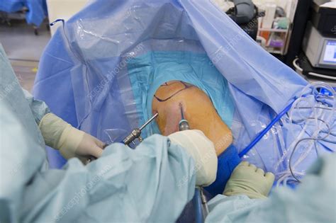 Shoulder Arthroscopy Stock Image C016 4099 Science Photo Library