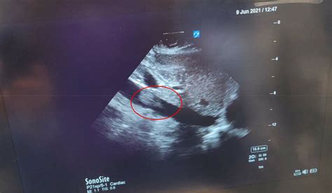 Pocus Showing Larger Particles In The Ivc Download Scientific Diagram