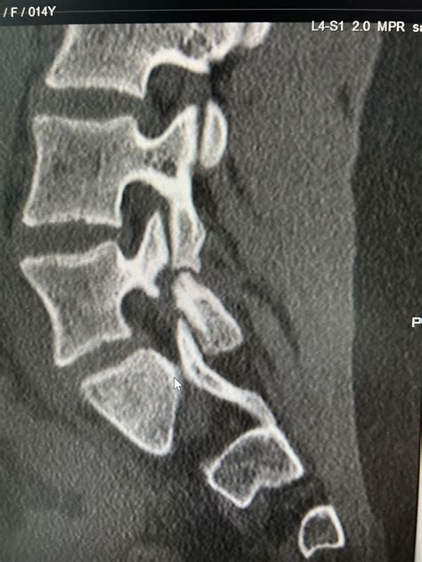 Inner Or Outer Bracement After Pars Repair 14 Year Old Patient