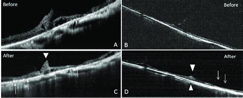 Left And Right Columns Show The Sd Oct Image Of Lattice Degeneration