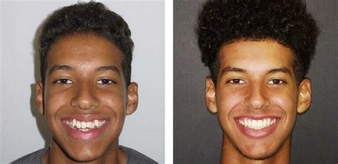 Clear Bracket Braces Best Ceramic Braces Orthodontist In Temecula