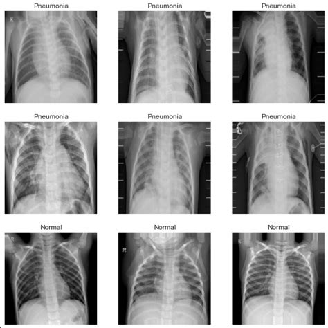 GitHub Clo X Ray Pneumonia Classification Classifying X Ray Images With Convolutional