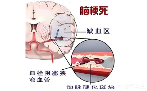 脑梗死 河洛星辰