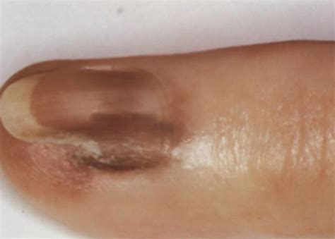 Subungual Melanoma Pictures Symptoms Diagnosis Treatment