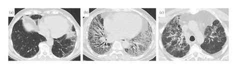 A Radiographic Probable Uip Pattern Patient 1 B Radiographic Download Scientific Diagram