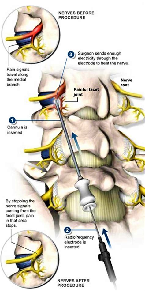 Radiofrequency Ablation Lumbar Radiofrequency Ablation Success Rate