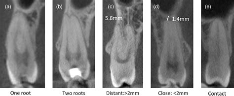 Cbct‐based Assessment Of The Anatomic Relationship Between Maxillary