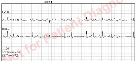 Afib W Wpw To Sinus W Weird Ectopy R Ekgs